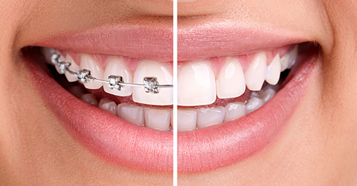 Invisalign Vs Ceramic Braces